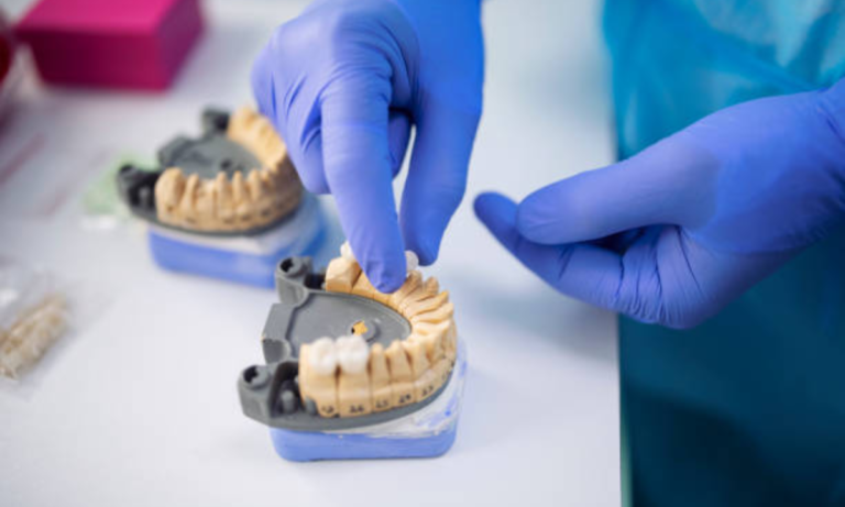 Dental Crowns Explained: Types, Uses, and Longevity