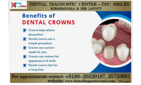 Dental Crowns Explained: Types, Uses, and Longevity