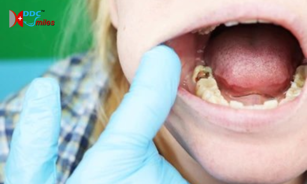 Treating a Deep Cavity with Root Canal Treatment in Bangalore